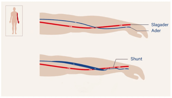 Shunt plaatsen voor hemodialyse (nierdialyse) | HMC