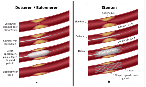 Angiografie (met dotteren en stenten) | HMC