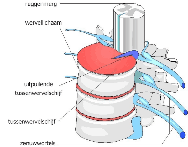 Hernia in de onderrug: behandeling door de neuroloog | HMC