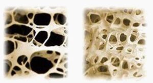 Screening op botontkalking (osteoporose) na een botbreuk | HMC