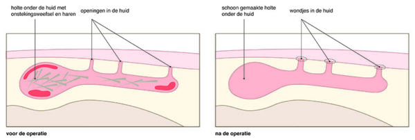Behandeling van een sinus pilonidalis (haarnestcyste) | HMC