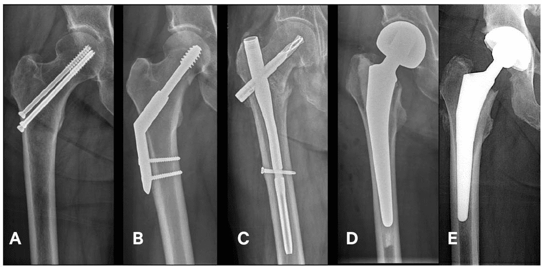 Ziektebeeld | Behandeling bij een gebroken heup | HMC