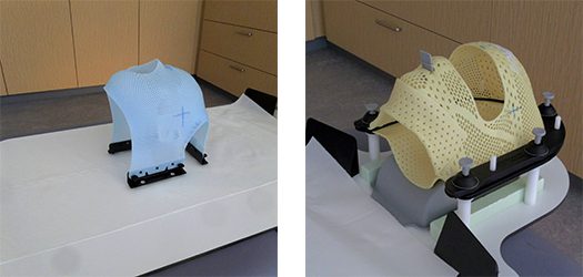 Bestraling bij hersentumor | HMC