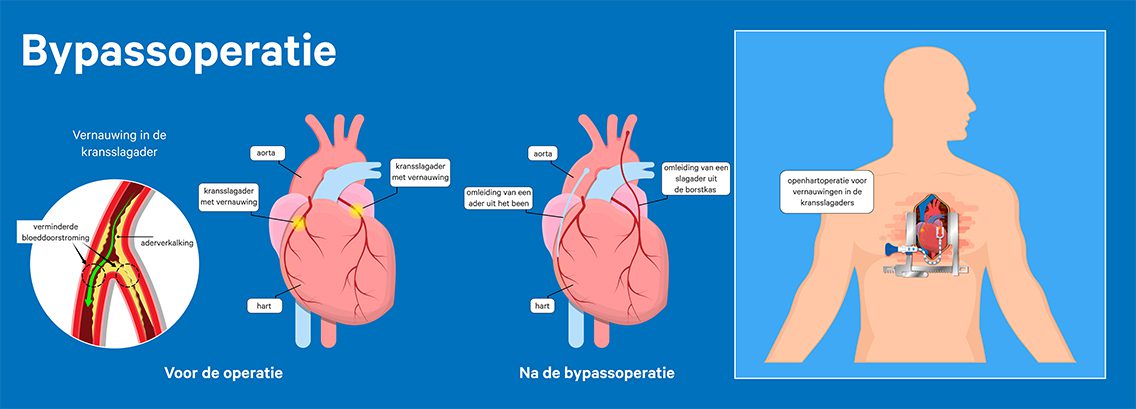Bypassoperatie | HMC
