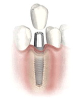 Implantaten plaatsen door de kaakchirurg | HMC