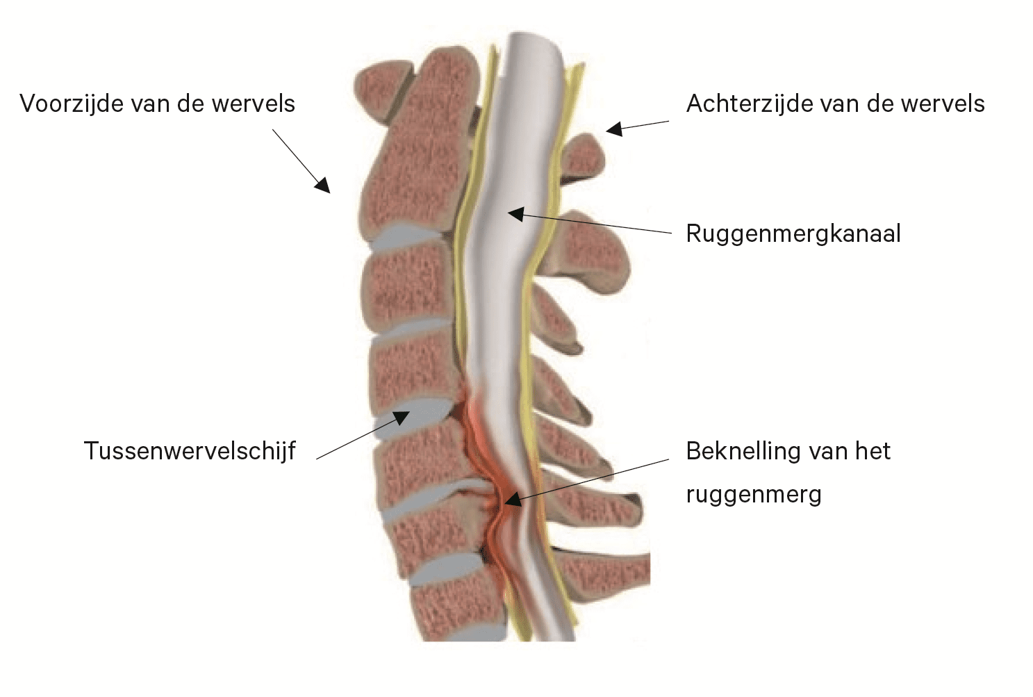 Vernauwing van het wervelkanaal in de nek | HMC